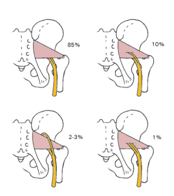 Piriformis Syndrome a hidden cause of sciatica - OsteoMag