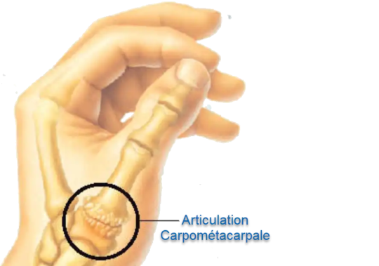 Arthrose de la Base du Pouce : Symptômes et Traitements - OsteoMag