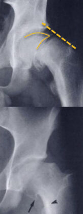 Épiphysiolyse Fémorale : Causes et Solutions de Traitement - OsteoMag