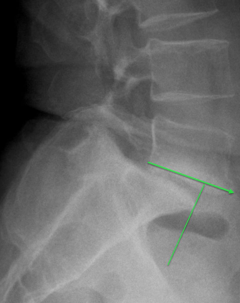 Managing Spondylolysis and Spondylolisthesis: A Complete Guide - OsteoMag