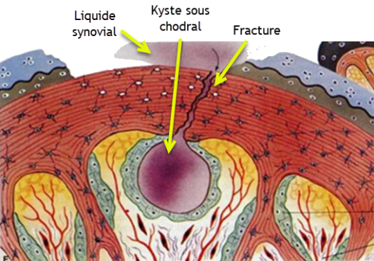 Kystes Sous-Chondraux : Causes, Symptômes et Options de Soins - OsteoMag