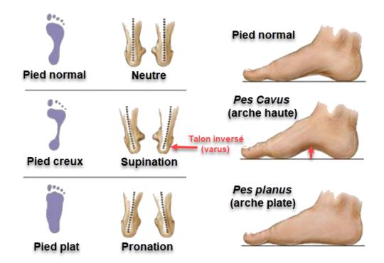 Le Pied Creux : Causes, Symptômes et Traitements - OsteoMag