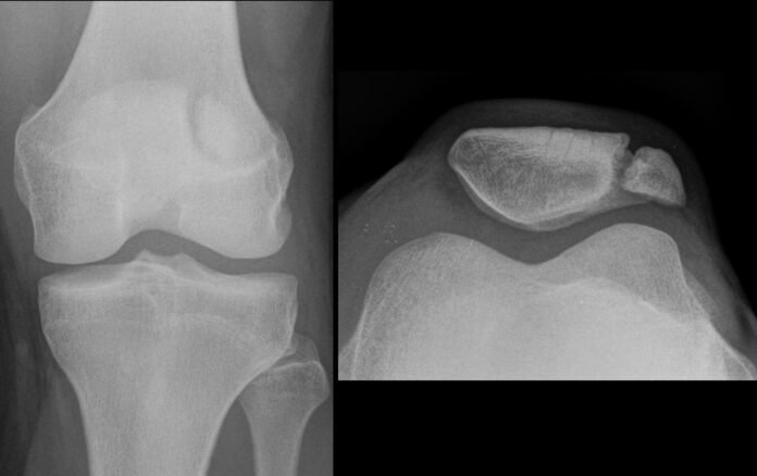 Patella alta | OsteoMag