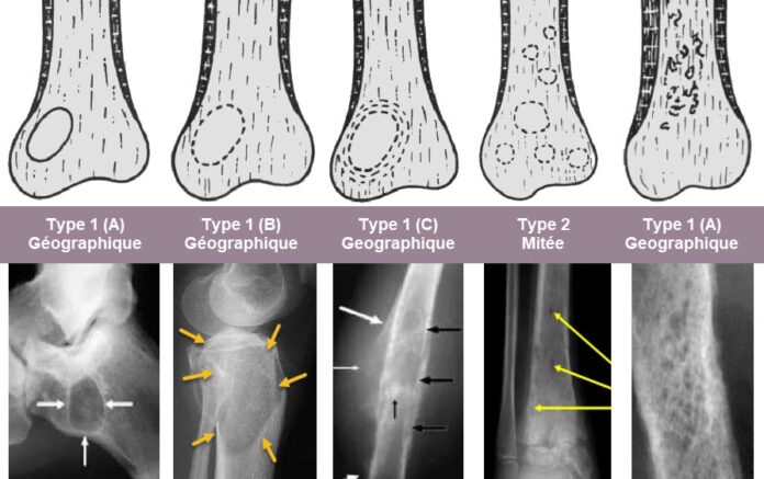 Bones tumors - OsteoMag