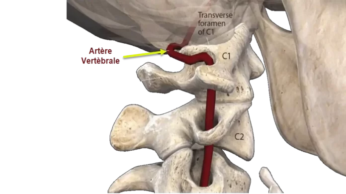 Vertebrobasilar insufficiency and cervical manipulation | OsteoMag