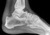 Haglund's Syndrome Explained: Relief from Heel Pain Starts Here - OsteoMag