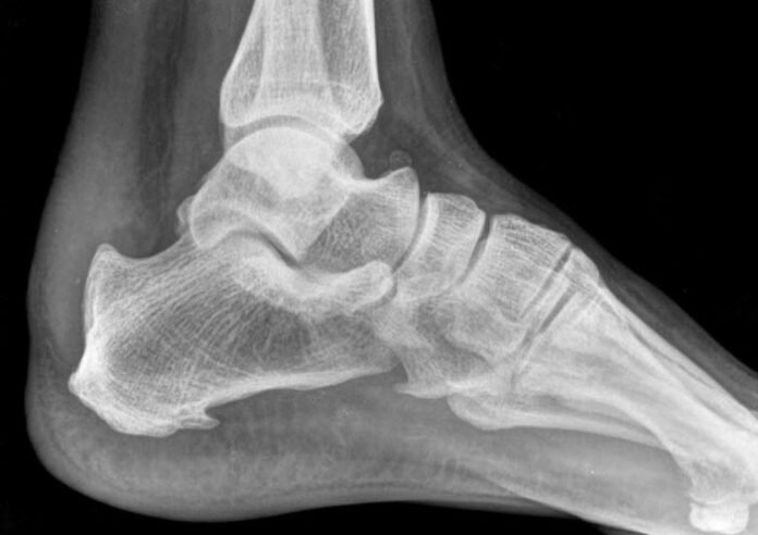 Haglund's Syndrome Explained: Relief from Heel Pain Starts Here - OsteoMag