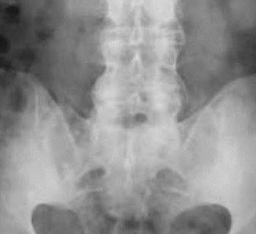 Ankylosing spondylitis AS | OsteoMag