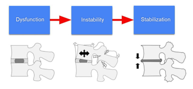 Kikaldy-Willis's Degenerative Cascade: Understanding the Process - OsteoMag