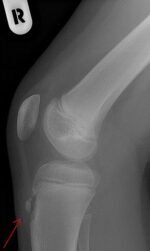 Osgood-Schlatter Disease: Knee Pain in Growing Teens | OsteoMag