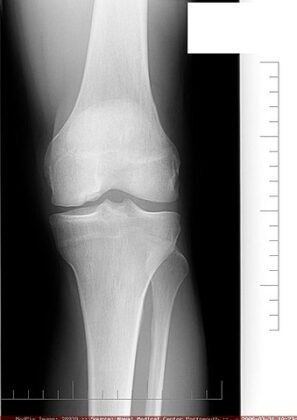 Osteochondritis dissecans (OCD) of the knee - OsteoMag