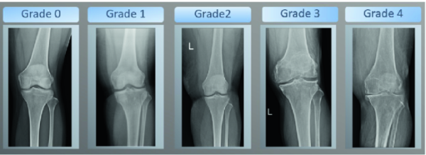 Arthrose du Genou : Causes, Symptômes et Solutions pour une Meilleure ...