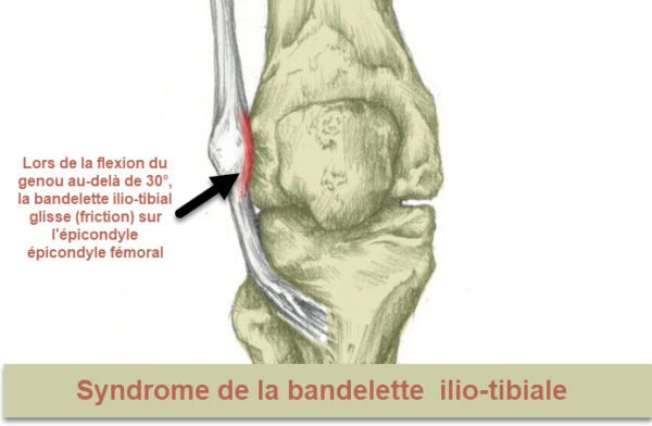 Comprendre et Gérer le Syndrome de la Bandelette Ilio-Tibiale - OsteoMag