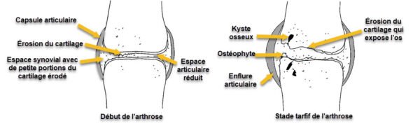 Comprendre l’Arthrose : Mécanismes et Impact Psychologique - OsteoMag