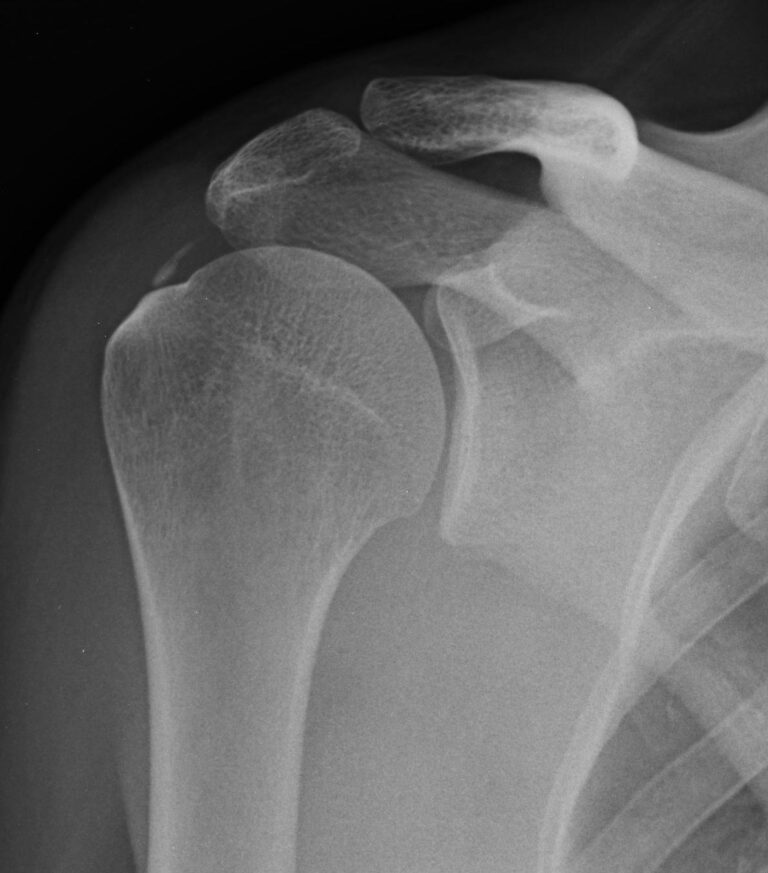 Shoulder calcific tendinopathy - OsteoMag