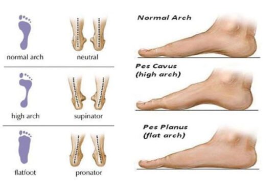 Flat Foot: Treatment Options and Preventive Care | OsteoMag