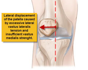 Lateral patella compression syndrome | OsteoMag