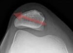 Lateral patella compression syndrome - OsteoMag