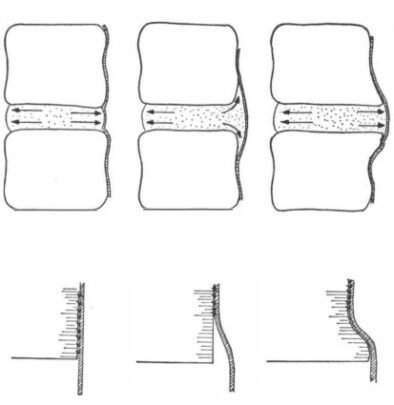 Managing Vertebral Spondylosis: Osteopathic Solutions - OsteoMag