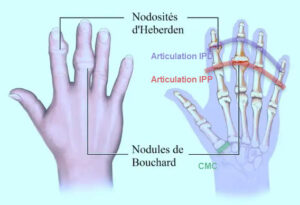 Arthrose de la Main : Symptômes, Causes et Approches Ostéopathiques ...