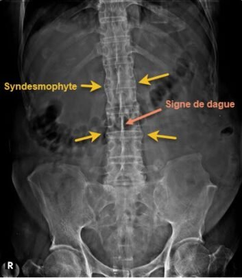 Ankylosing spondylitis AS | OsteoMag