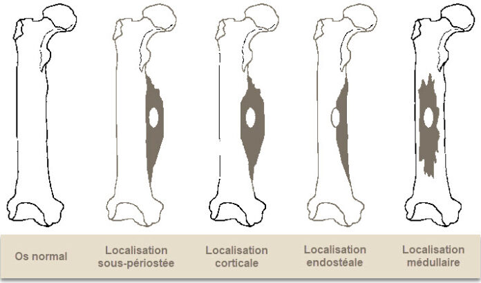 Bones tumors - OsteoMag