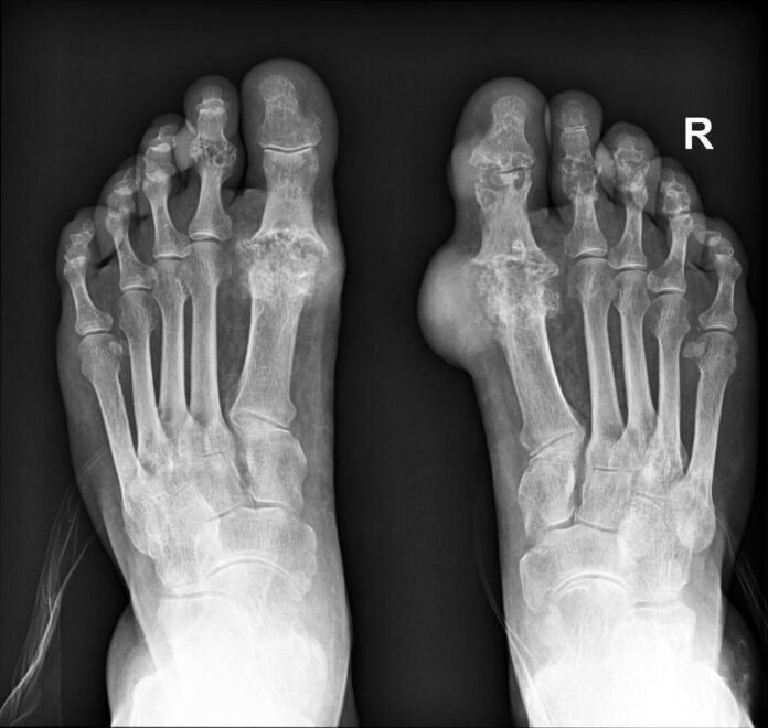La Goutte : Comprendre et Traiter cette Affection Articulaire | OsteoMag