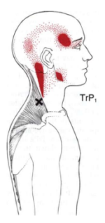Treatment of Trapezius Trigger Points by Ischemic Compression: An ...