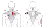 Treatment of Trapezius Trigger Points by Ischemic Compression: An ...
