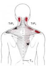 Treatment of Trapezius Trigger Points by Ischemic Compression: An ...