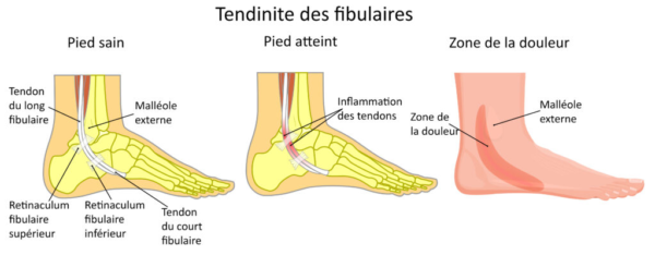 Troubles des tendons péroniers - OsteoMag