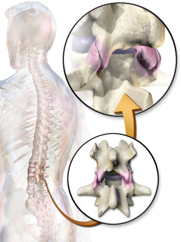 Managing Lumbar Facet Syndrome through Osteopathic Care - OsteoMag